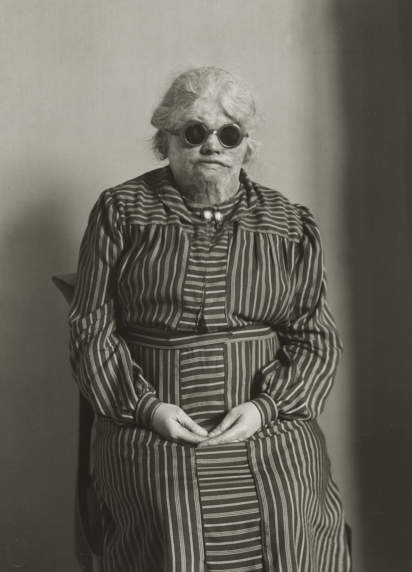 August Sander. Explosion Victim. c. 1930 | MoMA